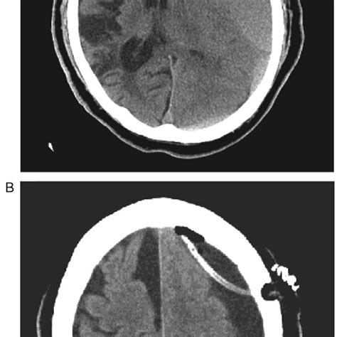 Head Computed Tomography Before A And After B Surgery Download Scientific Diagram