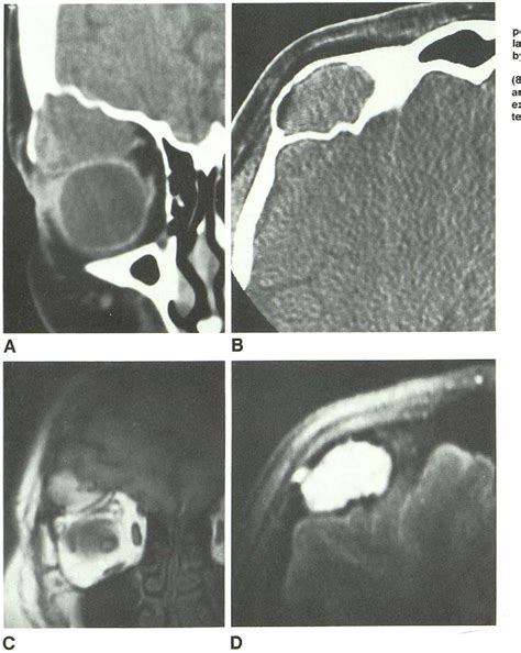 Figure 1 From Chronic Hematic Cysts Of The Orbit Semantic Scholar