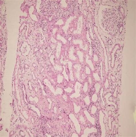 Light Microscopic Picture Of The Renal Interstitium Showing Significant
