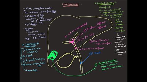 Cholangiocarcinoma Youtube