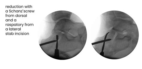 Calcaneal Fracture Both Sides Tongue Minimal Invasive Treatment Of