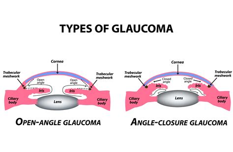 Is Glaucoma Hereditary｜brooklyn｜park Slope Eye