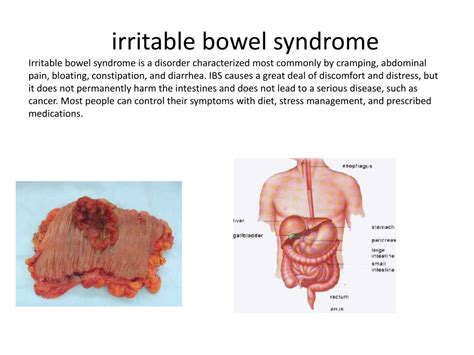 PPT A Ppendicitis Inflammation Of The Appendix PowerPoint Presentation ID
