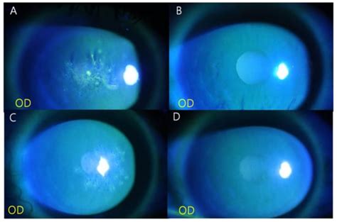 Bilateral Thygesons Superficial Punctate Keratitis With Dendritic Corneal Lesion A Case Report Bilateral Thygesons Superficial Punctate Keratitis With Dendritic Corneal Lesion A Case Report