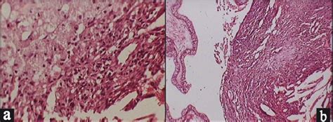 Xanthogranuloma Of The Choroid Plexus Image Xanthogranuloma Of The