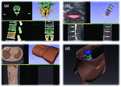 Segmentation Of The Vertebrae And Pelvic Bone Intervertebral Discs Download Scientific