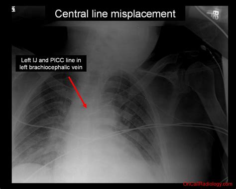 Picc In Innominate Vein