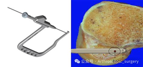 【手术技术】前交叉韧带重建中怎么样能精准的定位股骨隧道？ 好医术文章 好医术 赋能医生守护生命