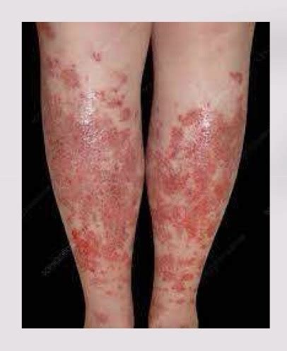 Epidermal Rashes ID Flashcards Quizlet