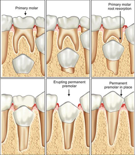 External Resorption Of Tooth