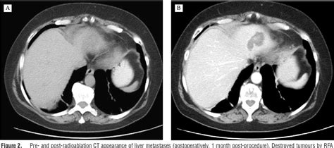 Figure 2 From Simultaneous Approach Of Colo Rectal And Hepatic Lesions