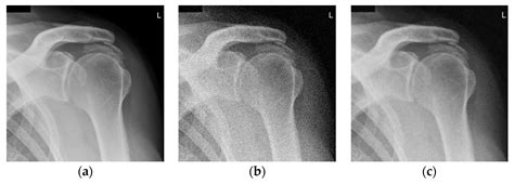 Denoising Of X Ray Images Using The Adaptive Algorithm Based On The Lpa Rici Algorithm