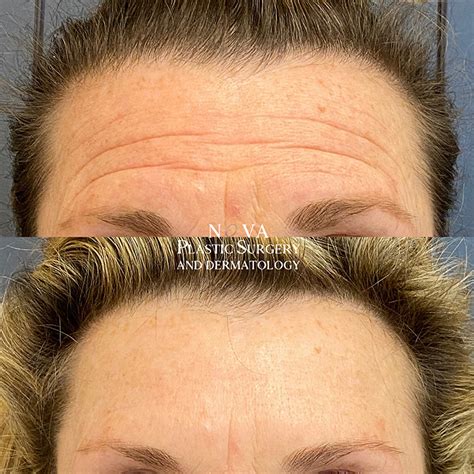 Botox Side Effects Forehead