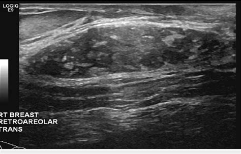 Ultrasound Of The Right Breast Transverse View Download Scientific