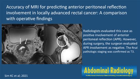 Peritoneal Reflection Sigmoid
