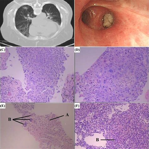 Computed Tomography‐guided Percutaneous Needle Biopsy Of A Lung Lesion