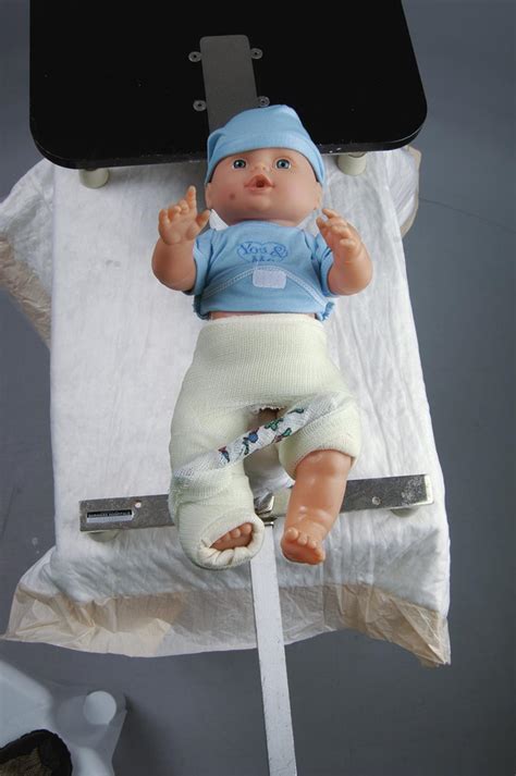 Lower Extremity Splints And Casts Clinical Tree