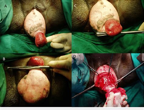 Uterine Prolapse Grading Pelvic Organ Prolapse The Bmj