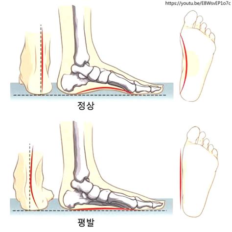 아이플러스 후기와 건강정보 평발 편평족