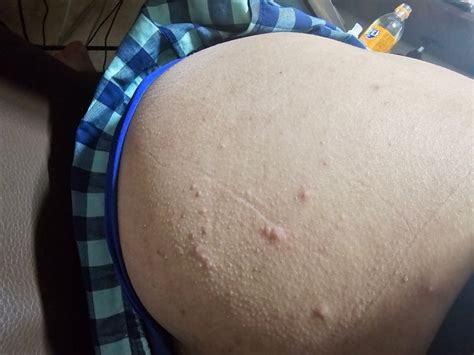 엉덩이 피부 지식in