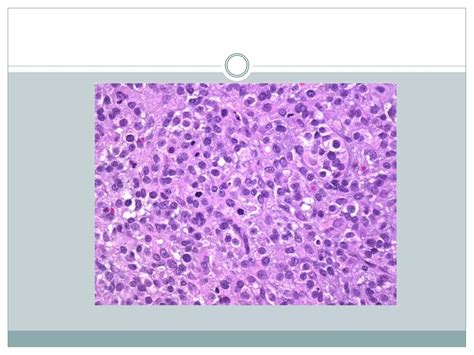 Sex Cord Stromal Tumors Pathology Pptx