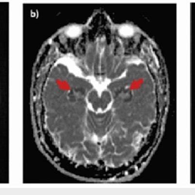 Brain MRI In Case 2 Axial Views A Diffusion Weighted Imaging B Download Scientific Diagram