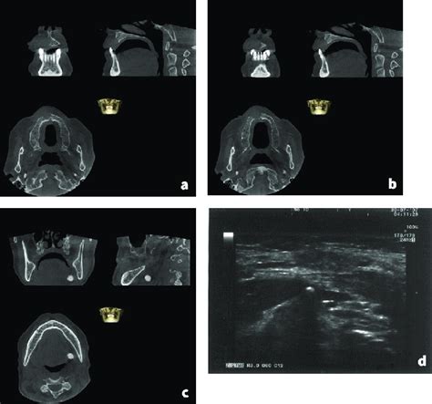 A Cbct Sections Of The Cgcg Note The Buccal And Palatinal Bone Cortex