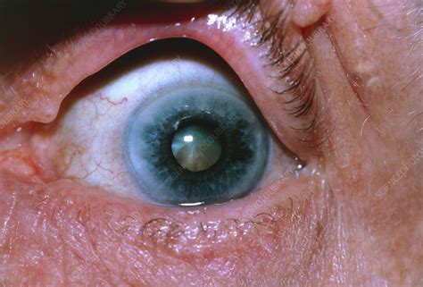 Corneal Arcus