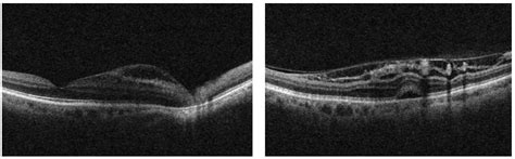 Case Report Peripapillary Retinoschisis In A Patient With Severe