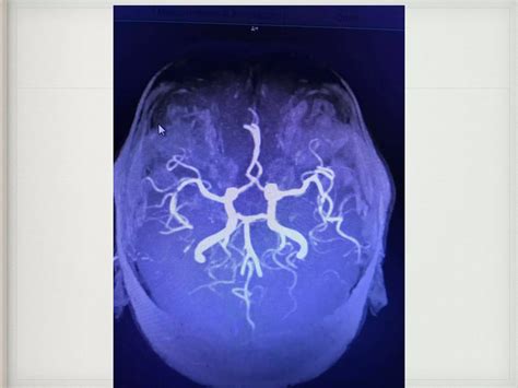 Cns Vasculitis Primary Vs Secondary Ppt