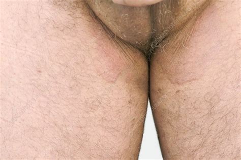 Erythrasma Skin Infection Stock Image C Science Photo Library