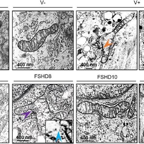 Mitochondrial Ultrastructure Abnormalities Are Observed In