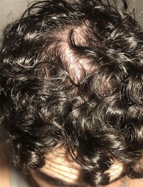 Is It Too Late Aggressive Diffuse Thinner R Hairloss