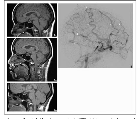 Figure 1 From Recurrent Syncope Due To Refractory Cerebral Venous Sinus Thrombosis And Transient