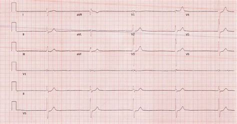 Initial Ekg Showing Bradycardia With A Rate Of 30 And Complete Heart