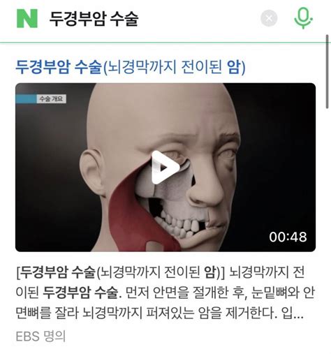 두경부암 걸리면 수술 어케 하는 줄 앎 인스티즈 Instiz 일상 카테고리