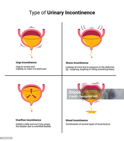 Ilustración De Urinary Incontinence Illustration Overactive Bladder