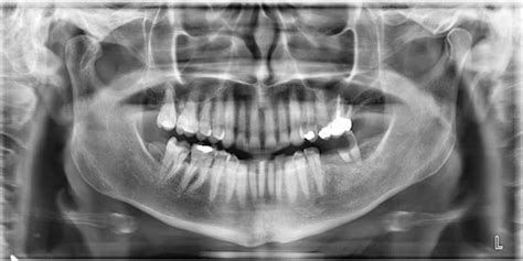 Torus Mandibular Cidem Sc