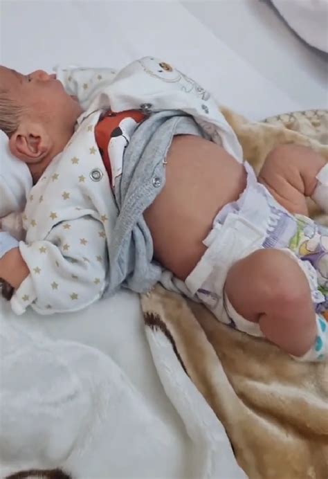 نوزادی که دوقلوی خود را در معده‌اش داشت تصاویر