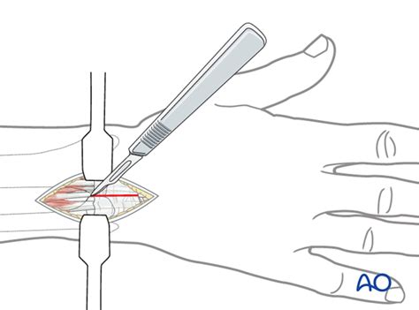 Orif Plating For Simple Fracture Of The Radius With Dislocation Of