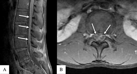 Cauda Equina Thickening An Approach To Mri Findings Clinical Radiology