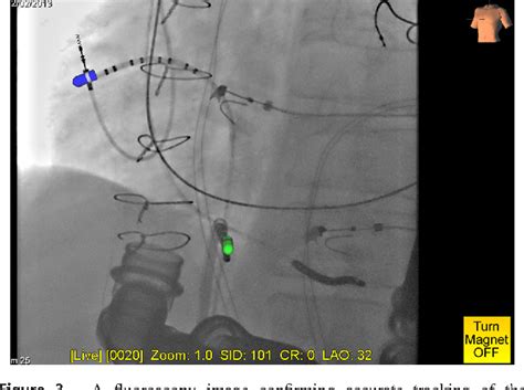 Figure 3 From Mediguide Assisted Atrial Flutter Ablation In A Patient