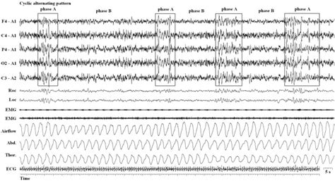 Cyclic Alternating Pattern Scoring In 3 Min Of Non Rapid Eye Movement Download Scientific