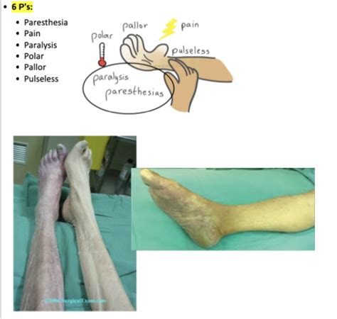 Acute Limb Ischemia Ali Flashcards Quizlet