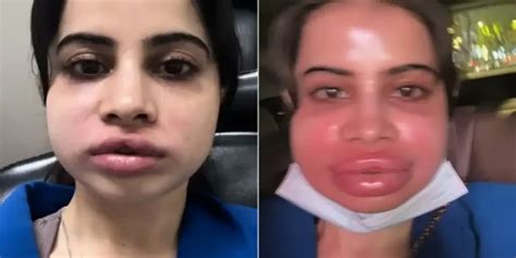 Urfi Javed Dissolves Lip Fillers