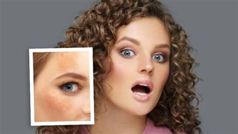 Hyperpigmentation On Buttocks Causes And Home Remedies Healthshots Hyperpigmentation On Buttocks Causes And Home Remedies Healthshots