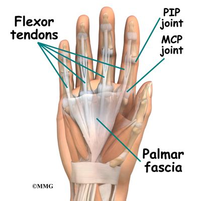 Dupuytrens Contracture Surgery