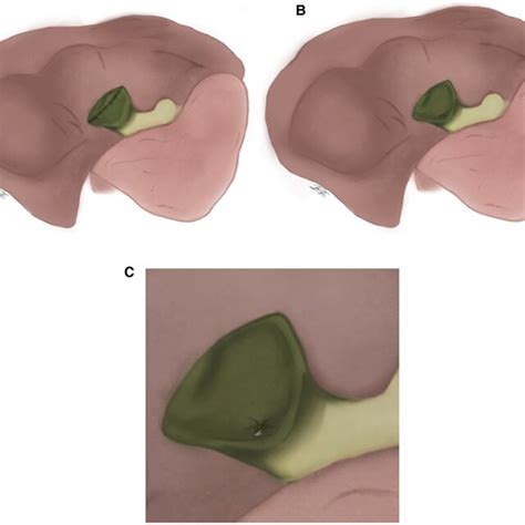 Hennemans Method Of Subtotal Cholecystectomy A Leaving The Download Scientific Diagram