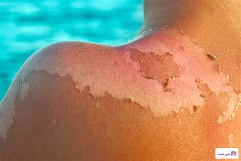 معرفی انواع بیماری‌های پوستی و علت آن‌ها آسان تست