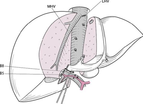 Left Hepatectomy Or Left Trisectionectomy With Resection Of The Caudate Lobe And Extrahepatic Left Hepatectomy Or Left Trisectionectomy With Resection Of The Caudate Lobe And Extrahepatic